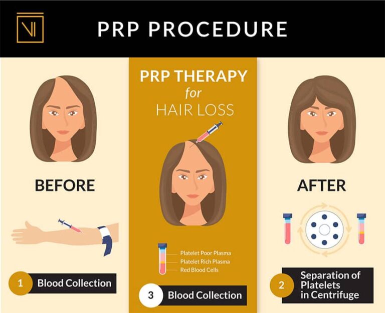 Platelet Rich Plasma Therapy For Healthy And Shiny Hair - Vitamin ...